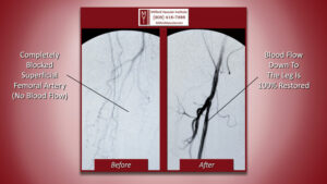 PAD Treatment in New Haven County for Peripheral Artery Disease