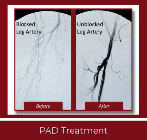 PAD Treatment in New Haven County for Peripheral Artery Disease