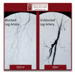 PAD Treatment in New Haven County for Peripheral Artery Disease