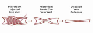 Varicose Veins Surgery New Haven - Safe and Quick Vein Removal