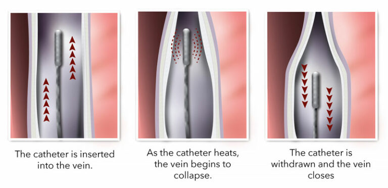 Varicose Veins Surgery New Haven - Safe and Quick Vein Removal