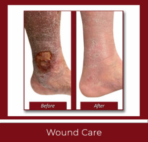 Wound Care Center at Milford Vascular Institute To Heal Your Wounds